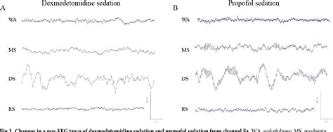 Figure 3 From Different Effects Of Propofol And Dexmedetomidine Sedation On Electroencephalogram