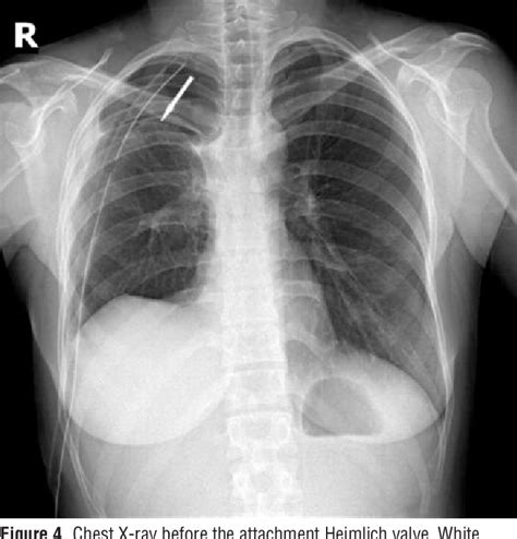 Chest Tube Flutter Valve Semantic Scholar