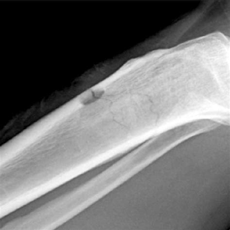 Case 2 Six Months After Tibial Fracture Download Scientific Diagram