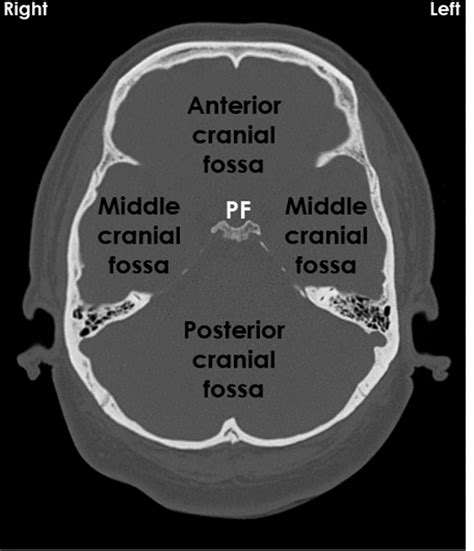 Interpretation Of Ncct Head Normal Findings Epomedicine