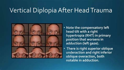 Disorders Of The Trochlear Nerve Ppt