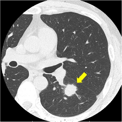 Chest Computed Tomography Image Demonstrating A Solid Nodule Arrow Download Scientific