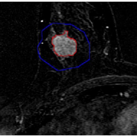 Semi Automatic Segmentation Result Of The Breast Lesion Based On The Download Scientific