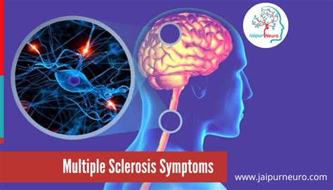 Multiple Sclerosis Symptoms Expert Guide By Dr Vikram Bohra
