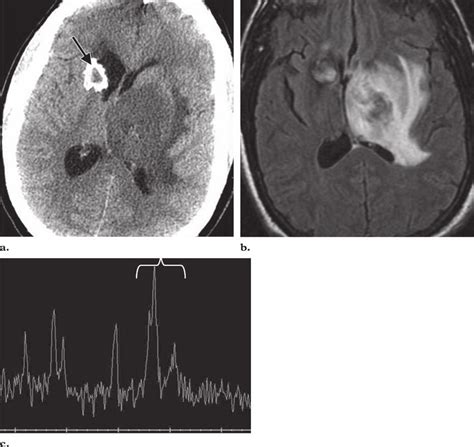 Acute Toxoplasmosis In A 37 Year Old Man With A Previous History Of