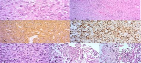 Photomicrographs Showing A And B Presence Of Pleomorphism High
