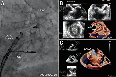 Left Atrial Appendage Occlusion Eurointervention