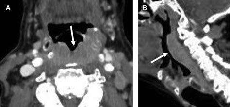 Mr Imaging Of Oral Cavity And Oropharyngeal Cancer Magnetic Resonance