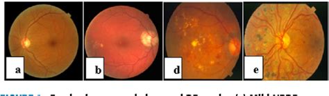 Figure 1 From Ensembled Deep Convolutional Generative Adversarial Network For Grading Imbalanced