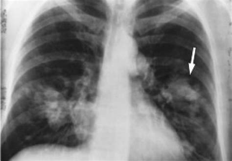 Рак на белия дроб Puls Bg