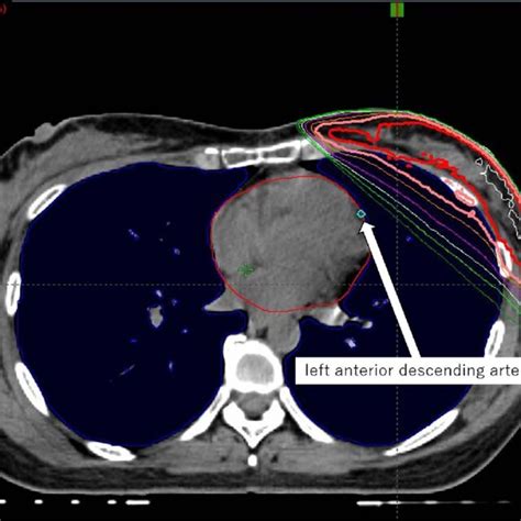 Example Of Dose Distribution By Vmat With Dibh For The Left Breast