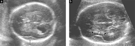Prenatal Ultrasound Findings Of Lissencephaly Associated With Millerdieker Syndrome And