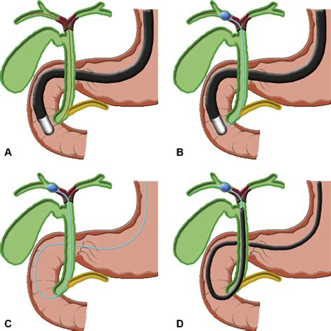 Figure 2 From A Newly Modified Access Balloon Catheter For Direct Peroral Cholangioscopy By