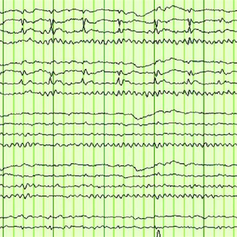Hypnagogic Hypersynchrony A Normal Eeg Variant [42] Download