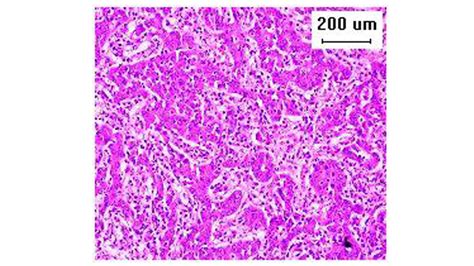 Video Fluorescent Laparoscopic Central Hepatectomy For Liver Cancer