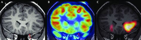 Multimodal Imaging With Interictal Fdg Pet Middle And Ictal Spect