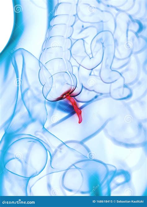 An Inflamed Appendix Stock Illustration Illustration Of Health 168618415