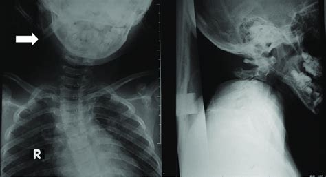 Cervical Aplateral With Discontinuities Shunt White Arrow