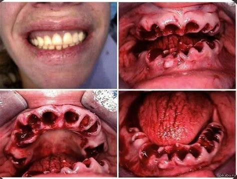 【閲覧注意】世界一苦しむ精神病患者「俺の歯がヤバイ」（画像あり） ポッカキットポッカキット