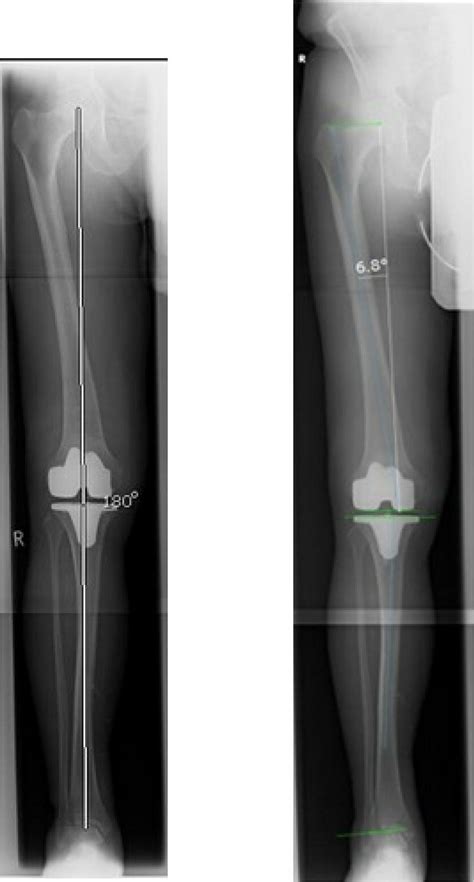 Postoperative Mechanical Axis And Difference Between Mechanical And Download Scientific Diagram