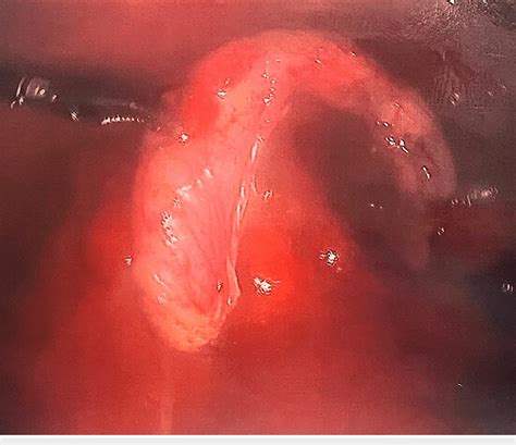 The Appendix Post Appendectomy Download Scientific Diagram