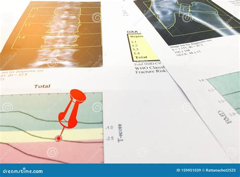 Dexa Densitometry Report Of Lumbar Wrist Joint Scan Royalty Free Stock