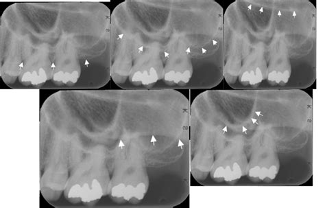 Maxilla Diagram Quizlet