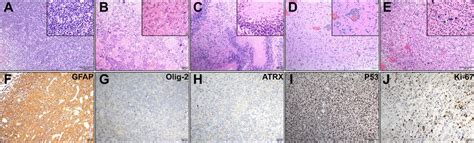 Histological Analysis Of Diffuse Hemispheric Glioma H G Mutant Download Scientific Diagram