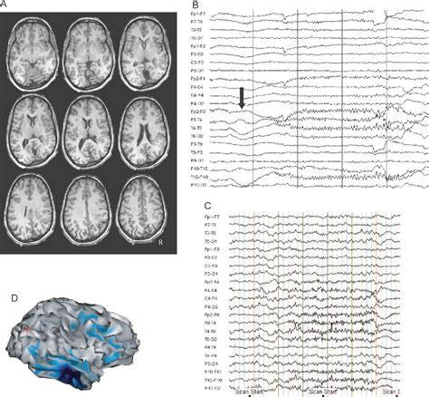 Structure Of Angular Gyrus Semantic Scholar