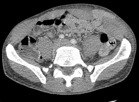 Spigelian Hernia Meded Cases