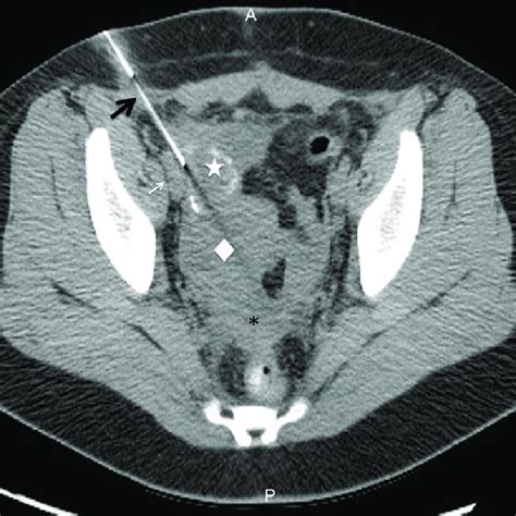 Rutherford Morrison Incision Download Scientific Diagram