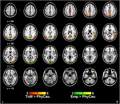 The Brain Activations Associated With The Tom And Empathy Conditions