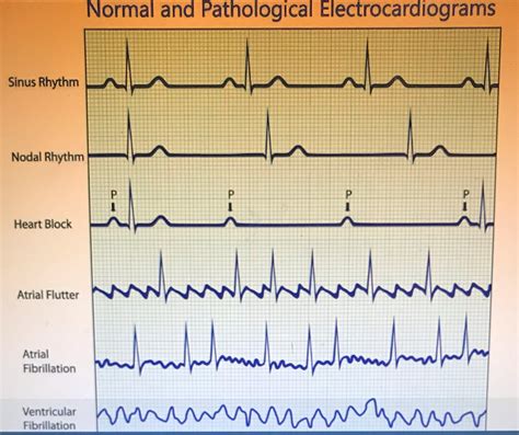 Solved Characteristics Of Abnormal Heart Rhythms Ecg Reading What Is