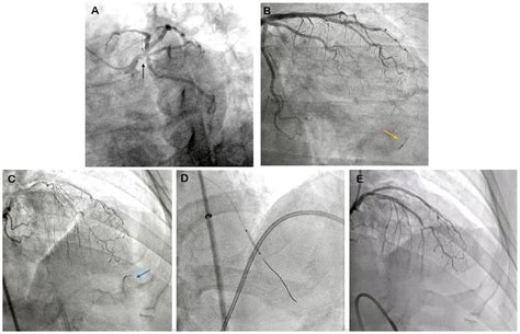 Case 2 Coronary Angiogram A Pre Pci Angiogram Revealed Lm
