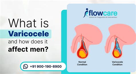 How Diet Can Impact Varicocele A Comprehensive Guide Flowcare