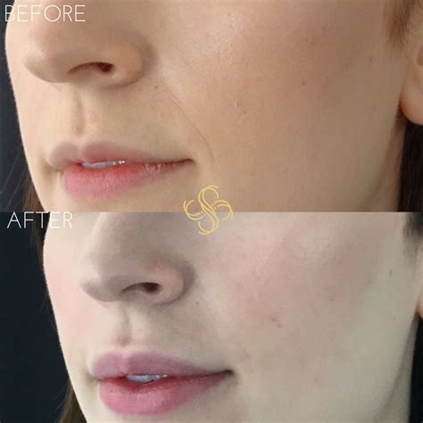 Perioral Gallery — Skintight Aesthetics