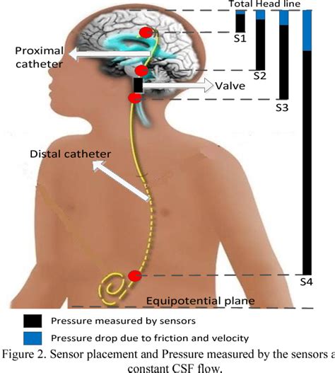 Figure 1 From A Wireless Monitoring System For Hydrocephalus Shunts Semantic Scholar