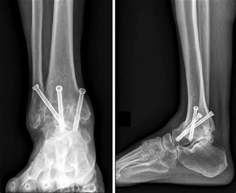 At The Postoperative 12th Week Figure Shows The Achieving Of