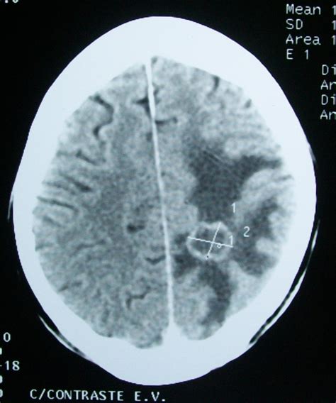 File Ct Brain Tumor  Wikipedia