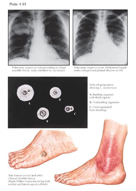 Cryptococcosis Pediagenosis