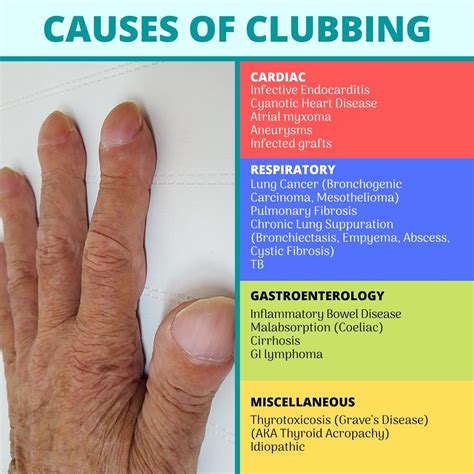 Rounded Fingertips Clubbing At Freddie Johson Blog