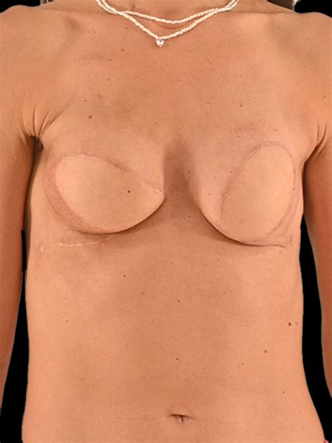 Implant To Flap Reconstruction Before And After Patient 01 Swba