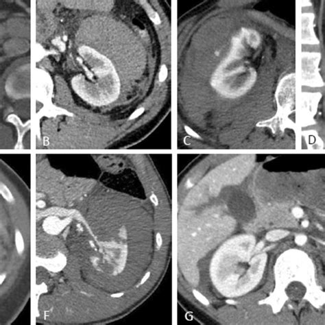The Classification For Renal Trauma By The American Association For
