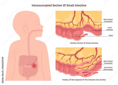 Intussusception Congenital Condition In Which Part Of The Intestine