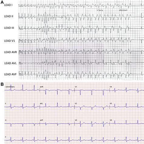 Supraventricular Tachycardia Triggering Polymorphic Ventricular Tachycardia Pmc