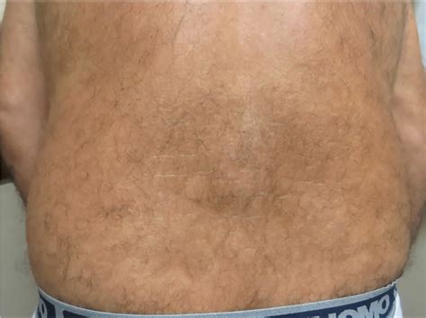 Secondary Syphilis Presenting As Leucoderma Syphiliticum Case Report