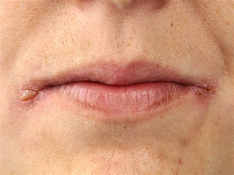 Vitamin Deficiency Angular Cheilitis At Jennifer Oliver Blog