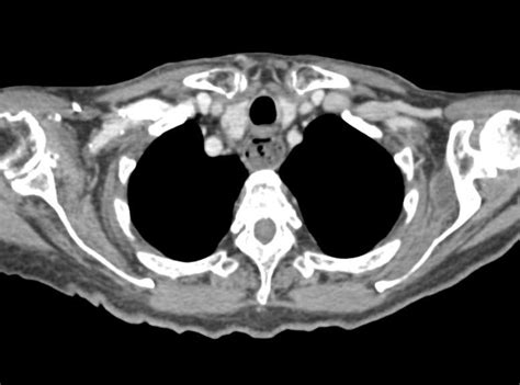 Esophageal Diverticulum Esophagus Radiology Case Studies Ctisus Ct