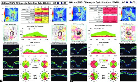 A And B Digital Hd Oct Scan Of The Onh And Rnfl Depicting Bilateral