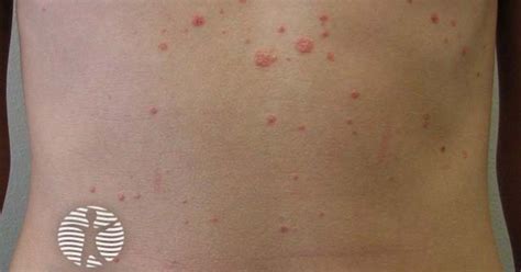 Guttate Psoriasis Image